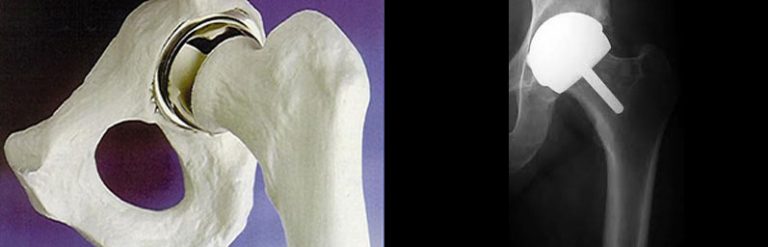 Hip Resurfacing – Dr Ireland