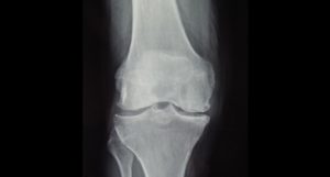Unicompartmental Knee Replacement – Dr Ireland